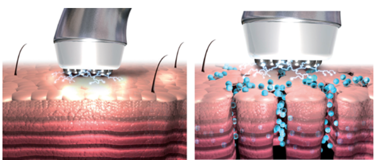 Battle Hair Loss With The Korean Scalp Stimulation Treatment Metropolitant